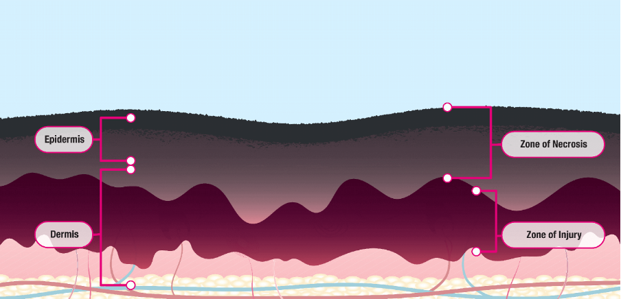 Burn Types | ActivHeal® Academy